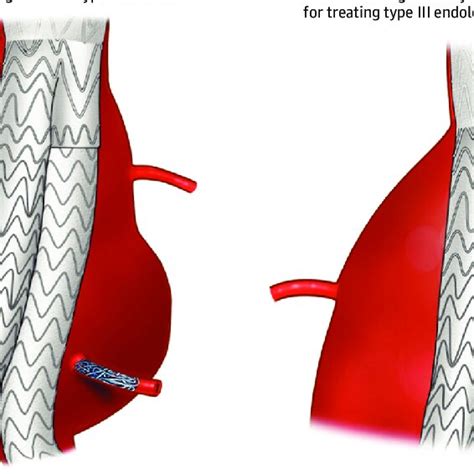 Endovascular Treatment For Type Ii And Type Iii Endoleaks Download Scientific Diagram