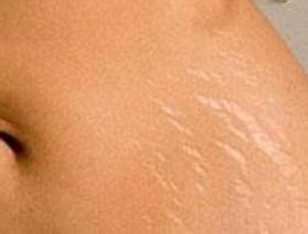 What Are Stretch Marks
