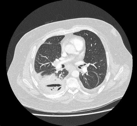Axial Ct Image Of The Chest Demonstrating Right Sided Lung Abscess And Download Scientific