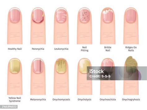 손톱 질환 건강 아픈 병 또는 다친 손톱 문제 손톱 감염 상태 치료 의료 피부과 진단 질병 손가락 호화로운 일러스트 작가 그래픽 손톱에 대한 스톡 벡터 아트 및 기타 이미지