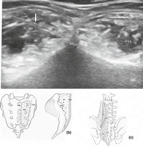Ultrasound‐guided Sacral Multifidus Plane Block For Analgesia Following