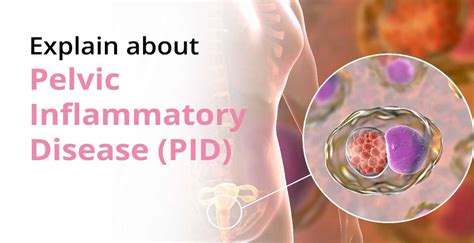 Pelvic Inflammatory Disease Pid Early Signs And Cure