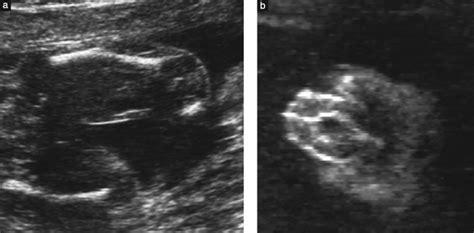 Ambiguous Genitalia Ultrasound Ambiguous Genitalia Ultrasound