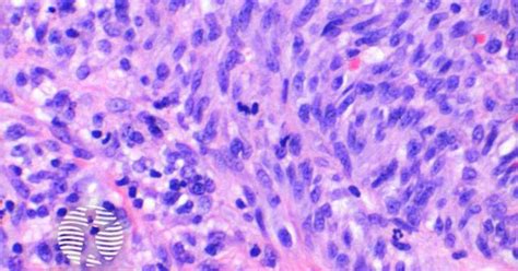 Dermnet® Kaposi Sarcoma Pathology Image