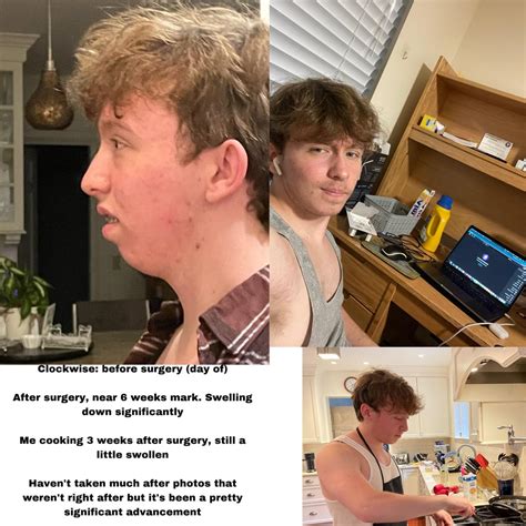 Profile View Before And After Jaw Surgery For Underbite R Jawsurgery