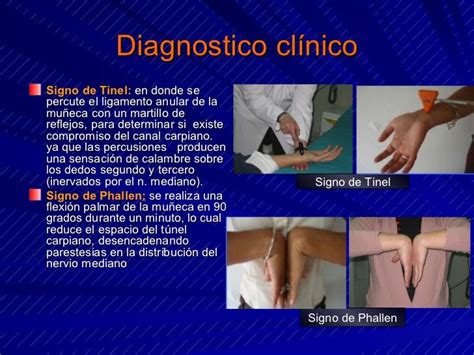 Sindrome Del Tunel Carpiano