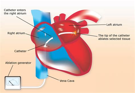 Cardiac Ablation Types Preparations Treatment And Risks