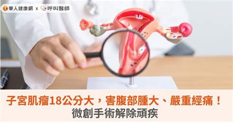 子宮肌瘤18公分大，害腹部腫大、嚴重經痛！微創手術解除頑疾 華人健康網 專業即時優質的健康新聞及資訊分享平台業即時優質的健康新聞及資訊分享平台