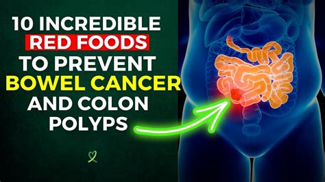 Best Foods To Prevent Colon Polyps At Bruce Huggins Blog