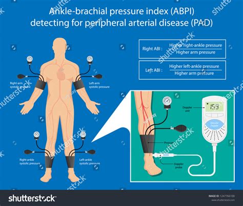 Peripheral Artery Disease Ankle Brachial Index Stock Vector Royalty
