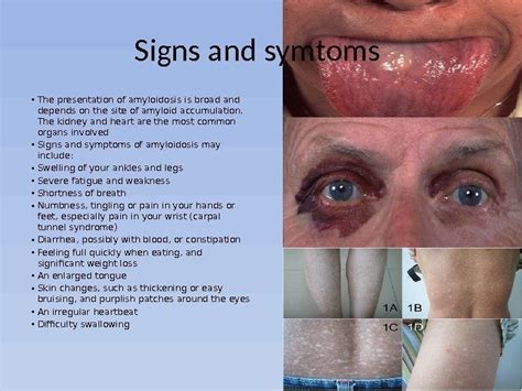 Amyloidosis By Samee Almusa 12012017 Amyloidosis