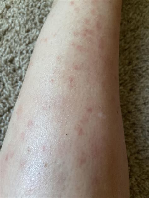 I Need Help Figuring Out What Kind Of Rash This Is R Outdoors