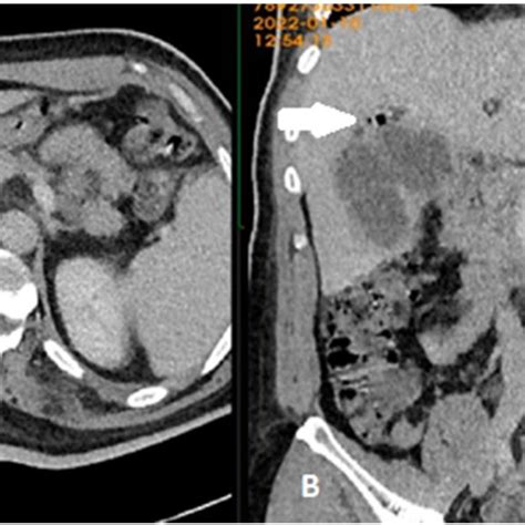 Abdominal Ct Shows Increased Size Of Gallbladder In Transverse A And