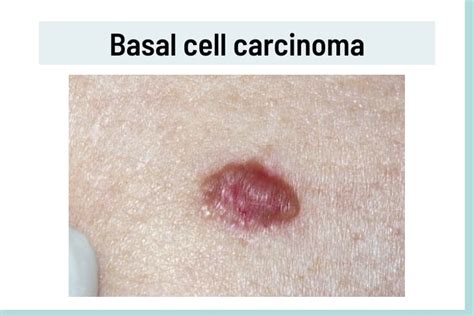 Raised Skin Bumps 44 Causes Pictures And Treatment