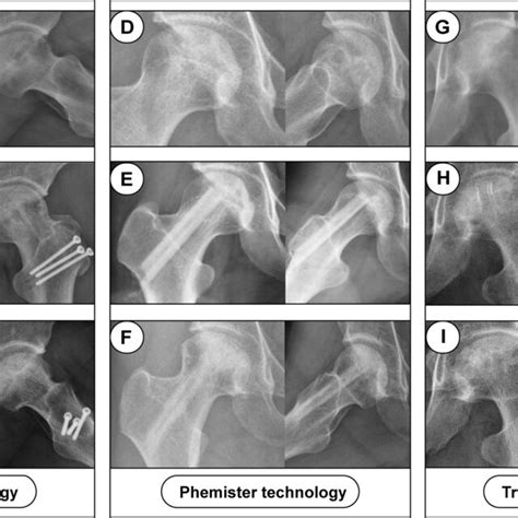 Aaos Classification Of Acetabular Bone Loss Download Table