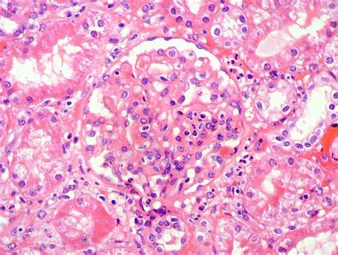 Microthrombi