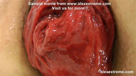 Extreme Anal Fisting Huge Dildos And Prolapse Compilation From Alexextreme