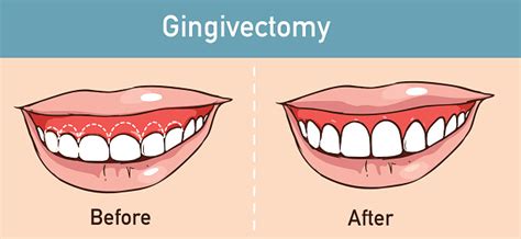 Vector Illüstration Of A Gingivectomy Stock Illustration Download