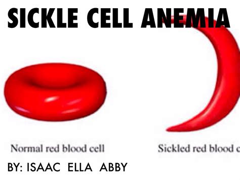 Sickle Cell Anemia Essay Outline