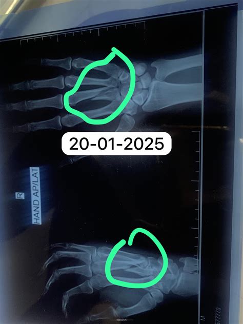 Ask A Orthopedic Surgeon Online For Bone Fractured Metacarpal Not Healing
