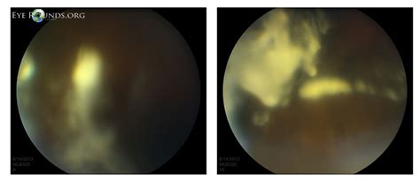 Atlas Entry Intravitreal Triamcinolone