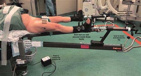 Specialised Table Hana Fracture Table Mizuho Osi That We Use With Download Scientific