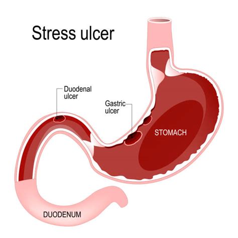 Peptic Ulcer Illustrations Royalty Free Vector Graphics And Clip Art Istock