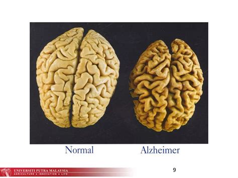 Neurocognitive Disorder Ncd Ppt