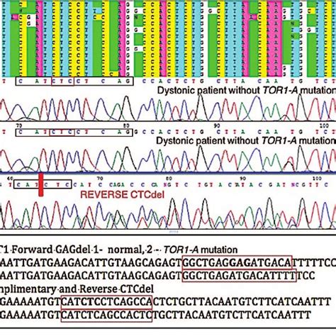 Tor1 A Mutation In A Patient With Generalized Dystonia Download