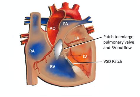 Tetralogy Of Fallot Pediatric Heart Specialists