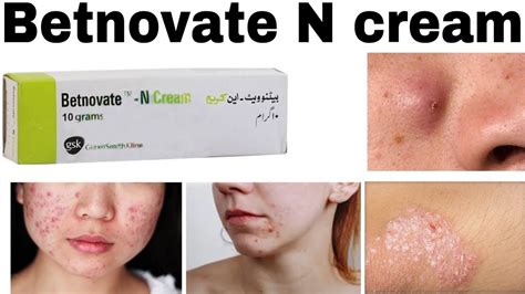 Best Cream For Nettle Rash At Tara Stallworth Blog