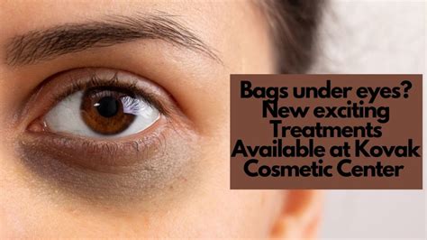 How To Get Rid Of Bags Under Eyes Quickly Without Makeup Saubhaya Makeup