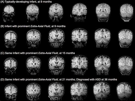 Mri To Improve Autism Diagnosis Science News