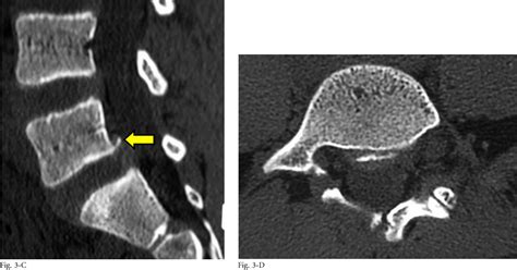 Figure 3 From Lumbar Posterior Apophyseal Ring Fracture Combined With Spondylolysis In Pediatric