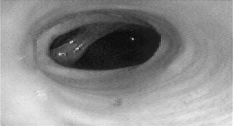 Recognition Of Proximal Bronchiectasis At Bronchoscopy The Journal Of Bronchology