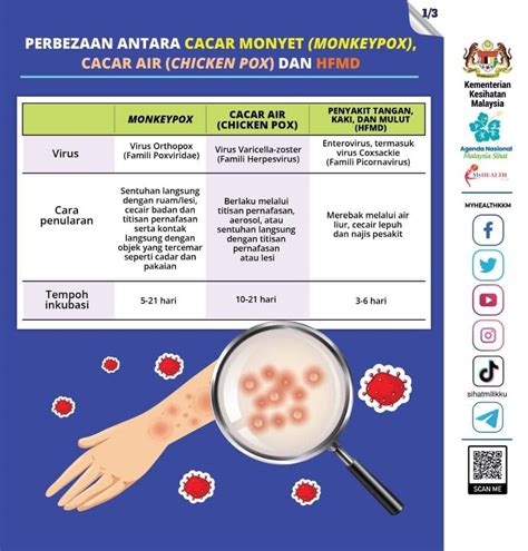 Cacar Air Chicken Pox Punca Tanda Simptom And Rawatan