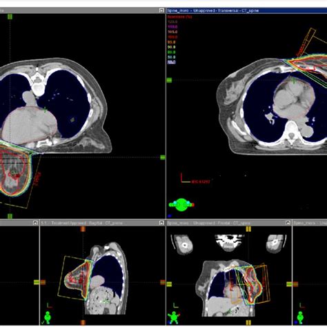 Typical Dose Distributions Of A Patients With A Pendulous Breast For Download Scientific