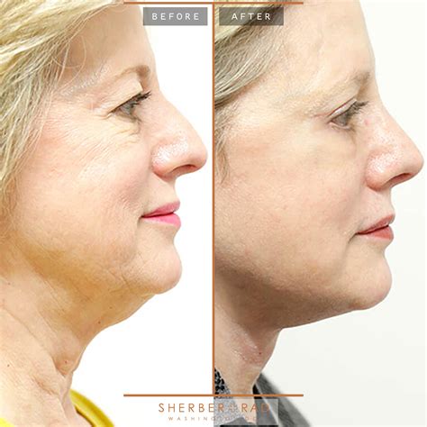 Male Neck Lift In Washington Dc Sherber Rad
