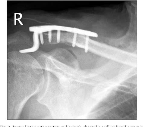 Figure 2 From Spontaneous Healing Of Acromial Stress Fracture Caused By