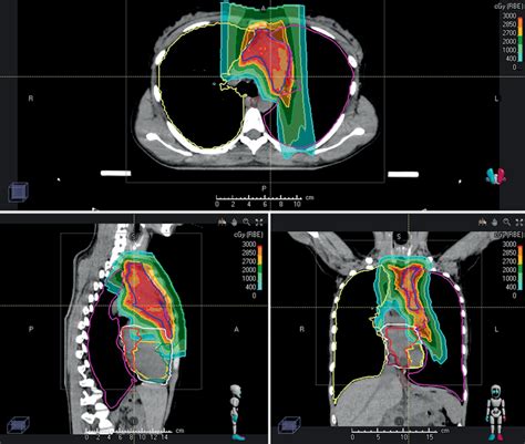 Typical Dose Distribution Of Active Scanning Proton Therapy Pt For