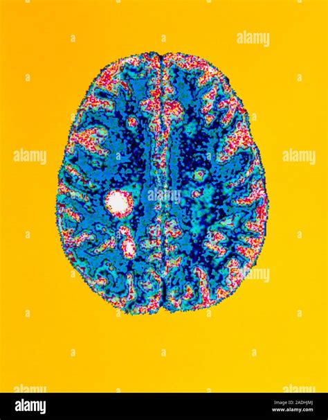 Multiple Sclerosis Coloured Magnetic Resonance Image MRI Scan Of An