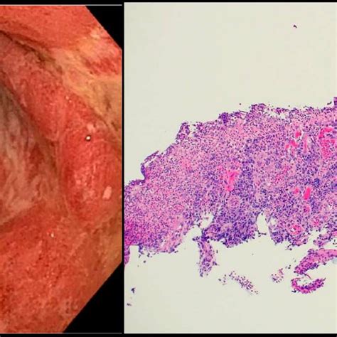 Colonoscopy Demonstrated Severe Mayo Endoscopy Score Proctosigmoid
