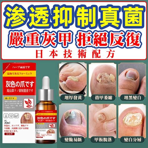 [現貨速發]灰指甲真菌治療液灰甲護理去灰甲厚甲軟甲凹凸不平灰甲清修復液抑菌修復灰指甲液治療指甲修復靚甲指甲保養去灰指甲 蝦皮購物