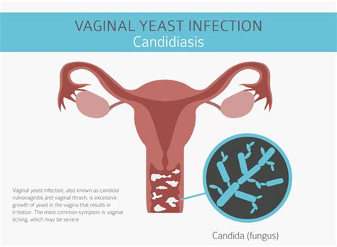 What Is A Yeast Infection Cool Springs Obstetrics And Gynecology