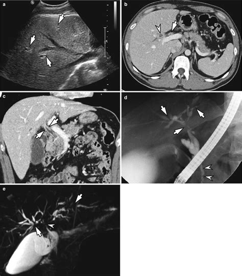 Cholangitis Radiology Key
