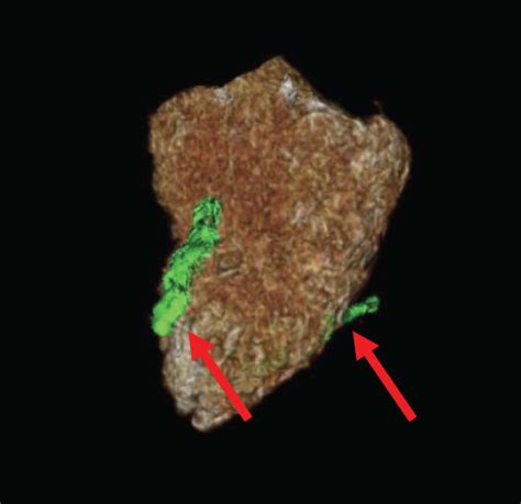 Fractured Ivc Filter Leg Embedded Within The Anterior Myocardium And Download Scientific