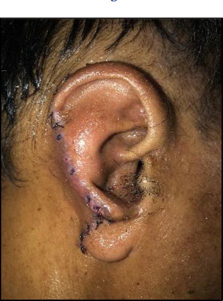 Figure 1 From The Management Of Auricular Defect Using Retroauricular Flap Semantic Scholar