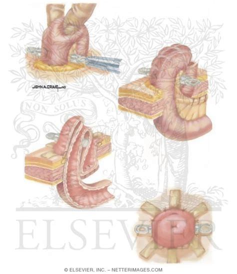 Types Of Stomas Loop And Ileostomy Technique