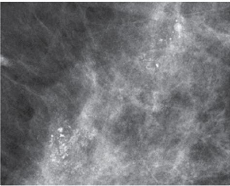 Breast Calcifications Radiology Key