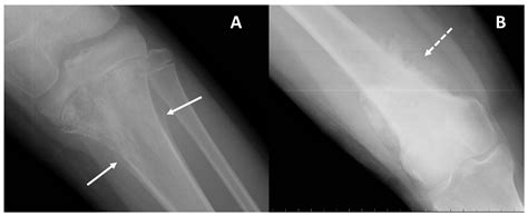 Imaging Of Osteosarcoma Presenting Findings Metastatic Patterns And Features Related To Prognosis